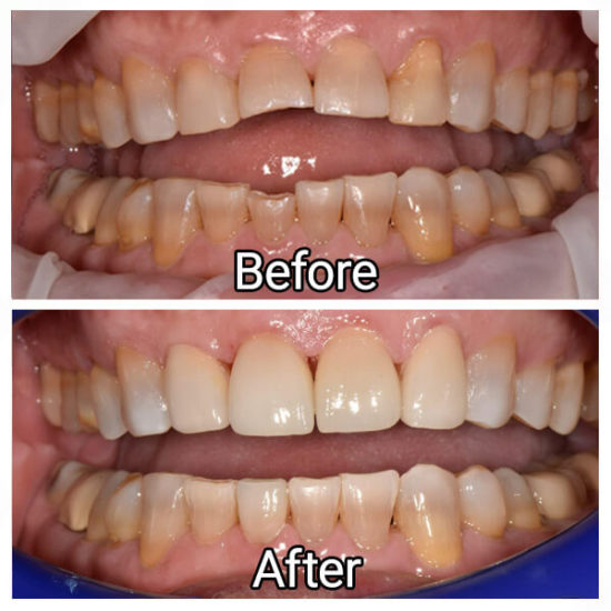 Dentist in Sacramento, CA - Smile Gallery Land Park Dental | Before & After